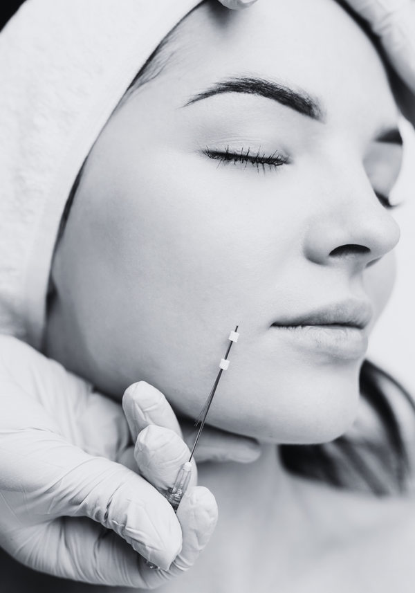 Skin Tightening and Lifting with PDO Threads | AgetoPerfection.com