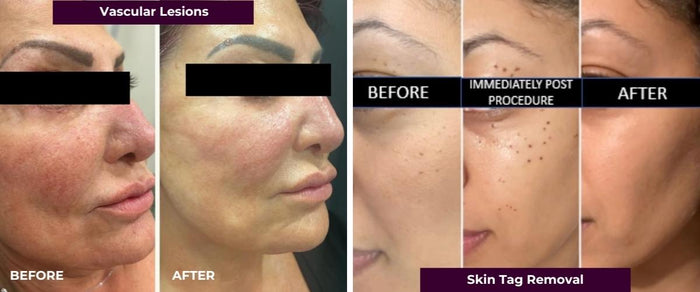 Vascular Lesions & Skin Tag Removal: Eliminating Unwanted Skin Tags ...