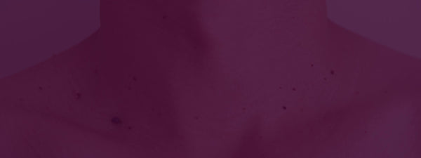 Vascular Lesions & Skin Tag Removal: Eliminating Unwanted Skin Tags ...